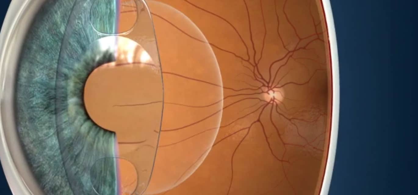 ICL Surgery | Katzen Eye Care Boynton Beach